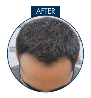 Hair Implant in India | Hair Implantation Centre in Delhi