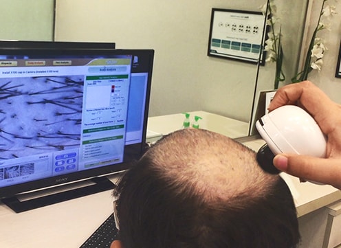 Hair Transplant: Trusted & Best Hair Transplant in India - DHI India