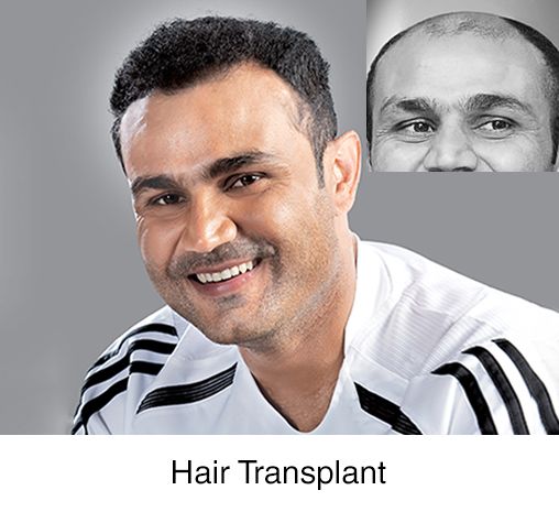 Hair Transplant: Trusted & Best Hair Transplant in India - DHI India