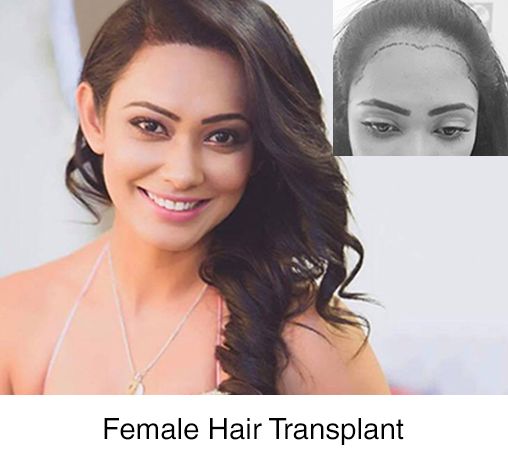 Hair Transplant: Trusted & Best Hair Transplant in India - DHI India