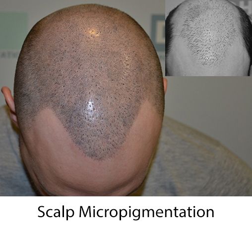 Hair Transplant: Trusted & Best Hair Transplant in India - DHI India